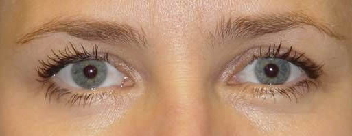 Blefaroptosis superior, estética palpebral