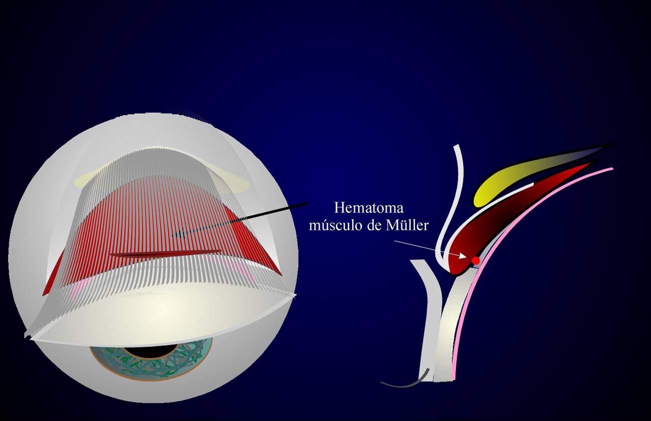ptosis palpebral causado por la blefaroplastia superior